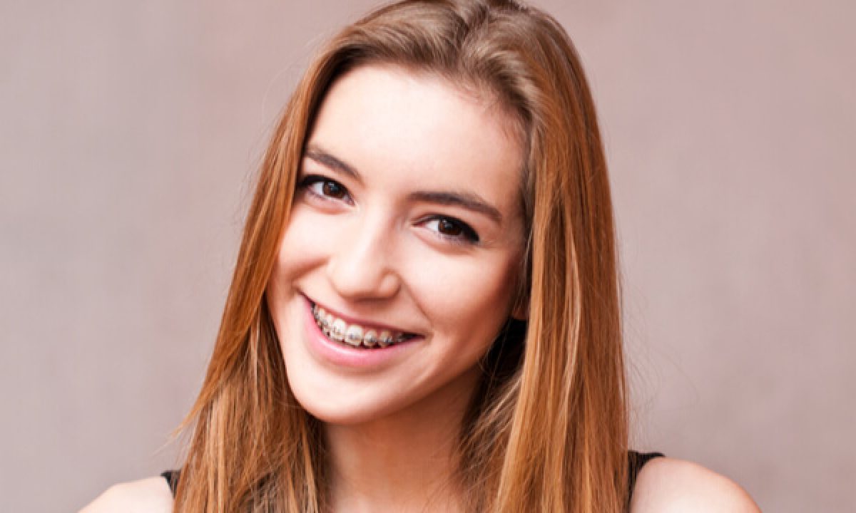 People With And Without Braces Before And After