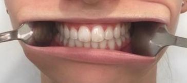 Teeth Assessment - No Gaps Dental